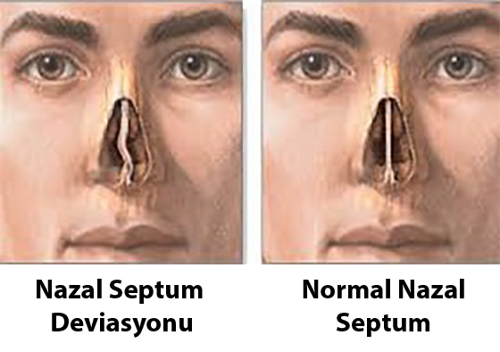 Burunda Kemik Eğriliği (Nazal Septum Deviasyonu) – Prof. Dr. Yücel Anadolu